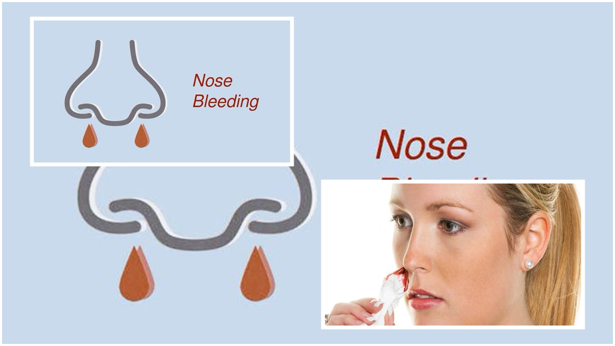 Nose Bleeding : નસકોરી ફુટવાની સમસ્યાથી છો પરેશાન, આ રીતે તાત્કાલિક ...