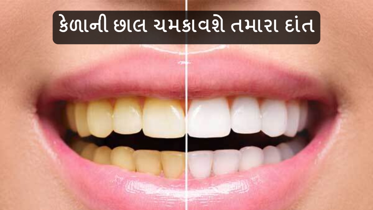 Teeth White Remedy: કેળાની છાલ ચમકાવશે તમારા દાંત, જાણી લો આ ઉપાય ...